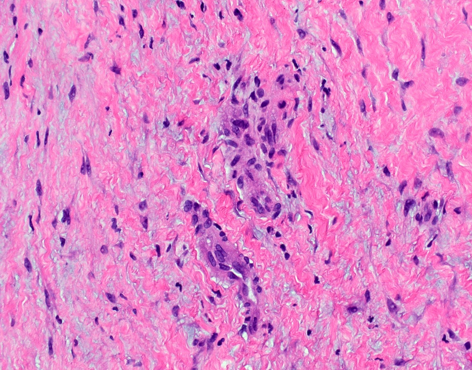 Pathology Outlines Egfr Mutation Specific Antibodies