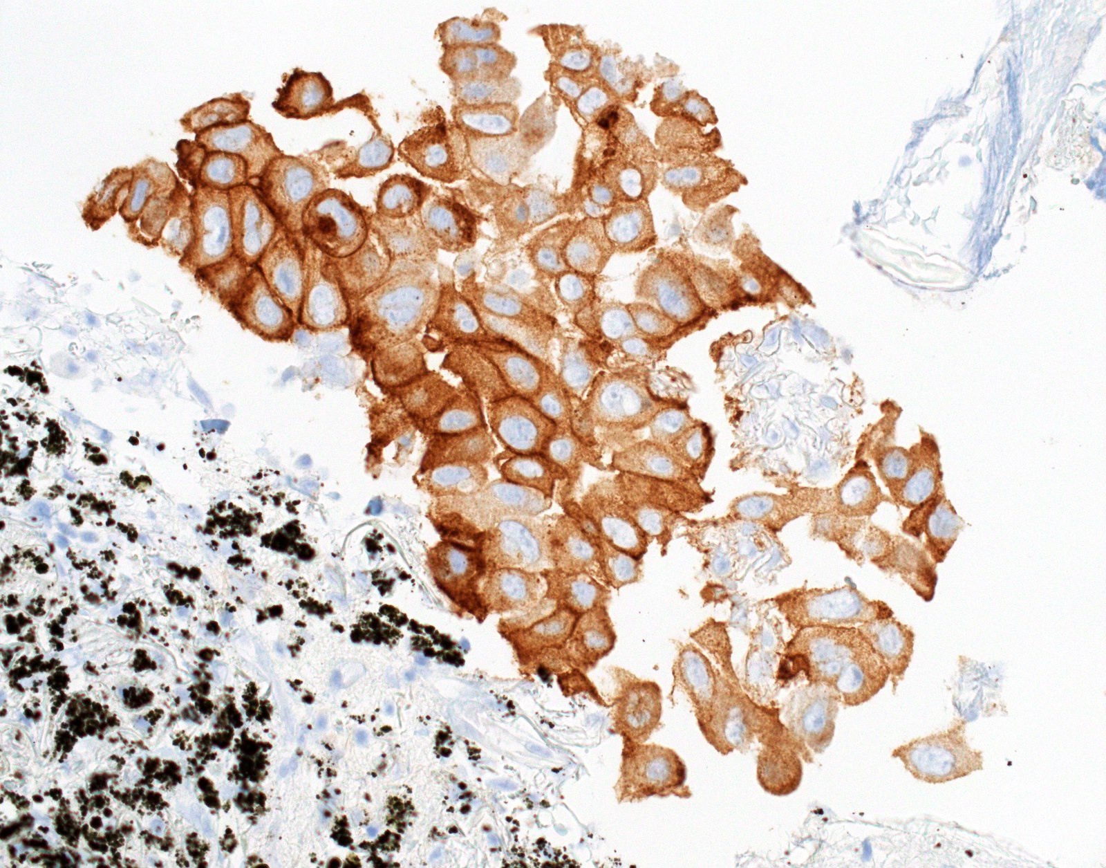 Pathology Outlines Egfr Mutation Specific Antibodies