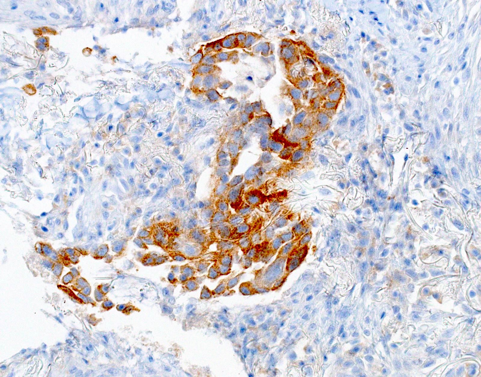 Pathology Outlines Egfr Mutation Specific Antibodies