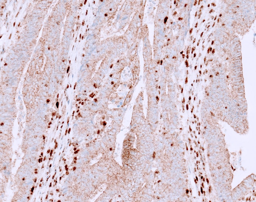 Pathology Outlines - Colon cancer biomarker testing (including MSI / Lynch)