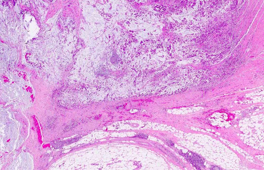 Pathology Outlines - Colon cancer biomarker testing (including MSI / Lynch)