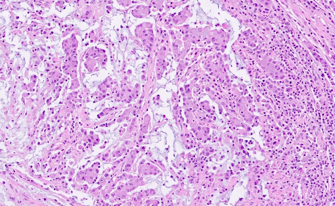 Pathology Outlines - Colon cancer biomarker testing (including MSI / Lynch)