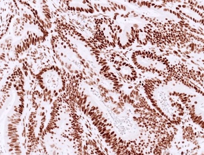 Pathology Outlines - Colon cancer biomarker testing (including MSI / Lynch)