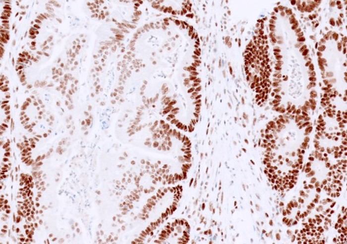 Pathology Outlines - Colon cancer biomarker testing (including MSI / Lynch)