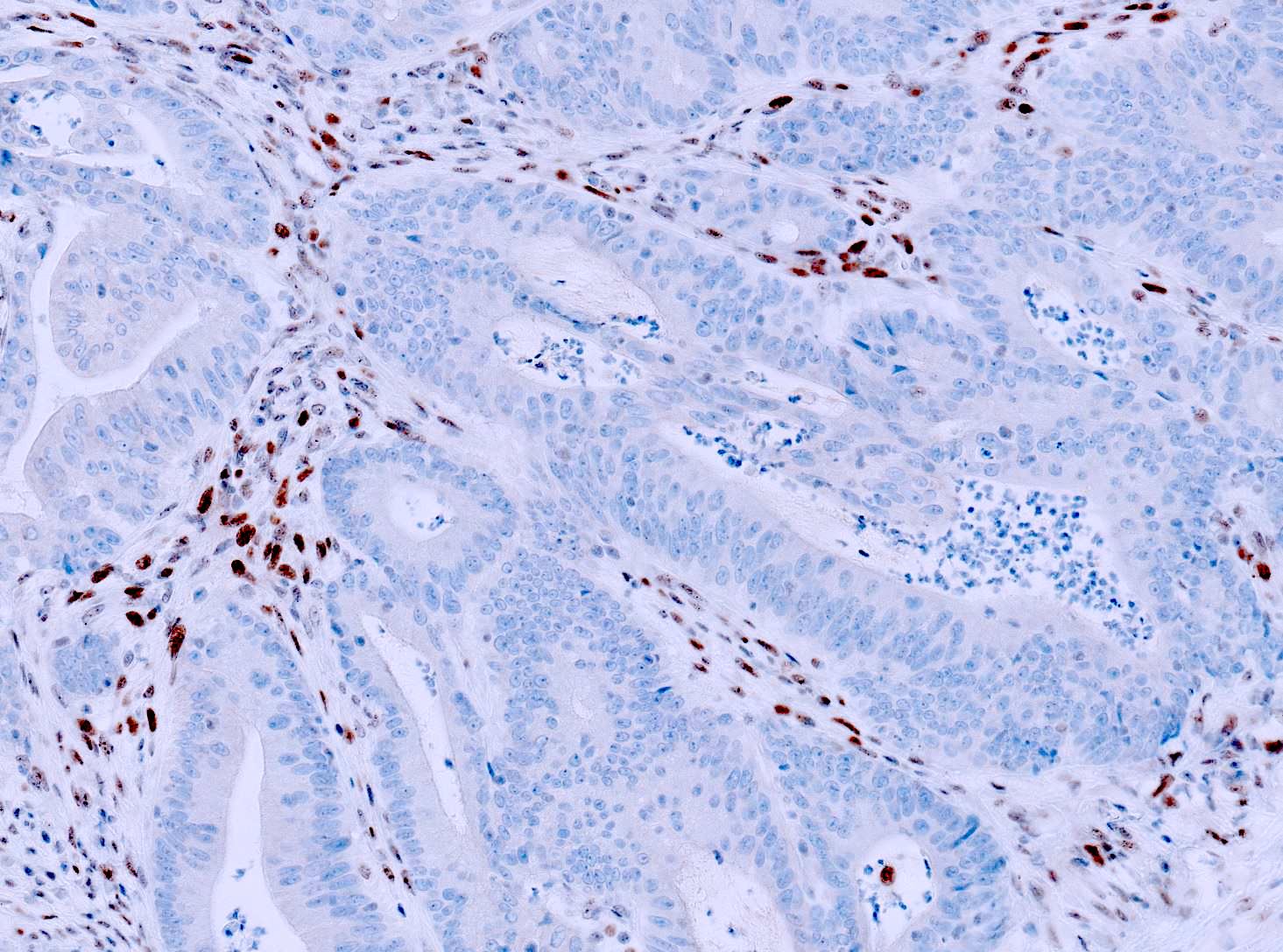 Pathology Outlines - Colon cancer biomarker testing (including MSI / Lynch)