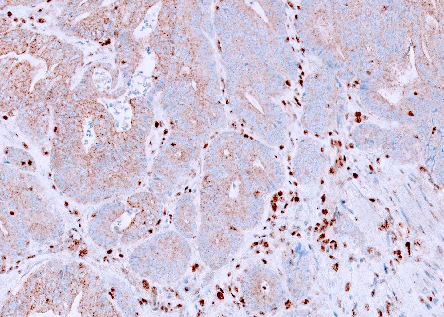 Pathology Outlines - Colon cancer biomarker testing (including MSI / Lynch)
