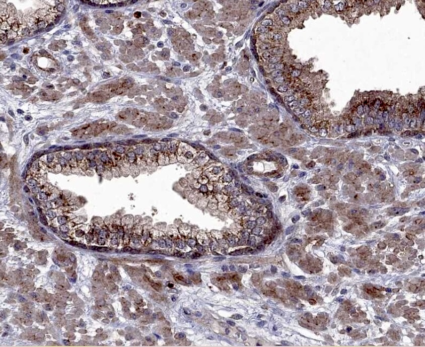 Pathology Outlines - PTEN