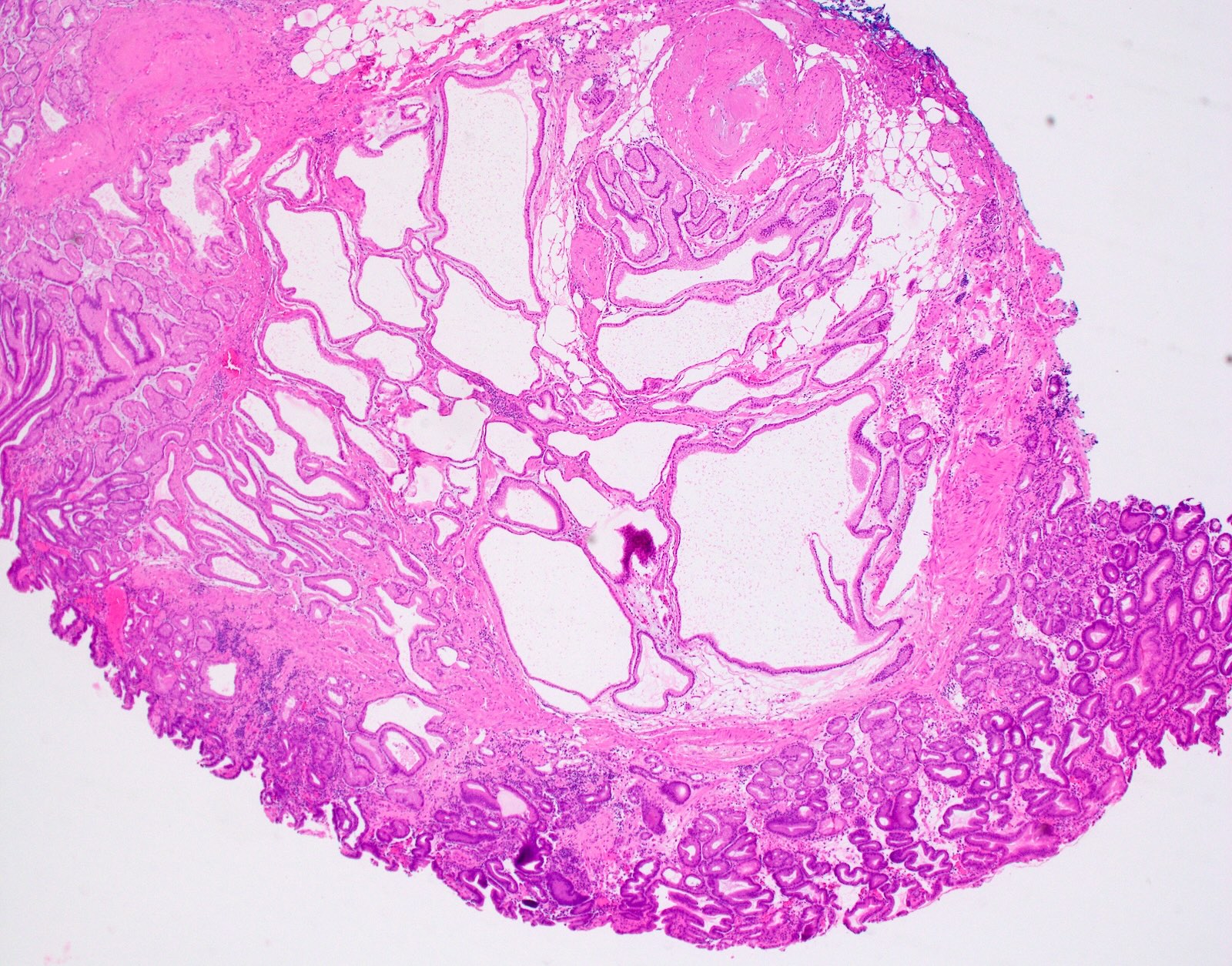 Pathology Outlines - Gastritis cystica polyposa