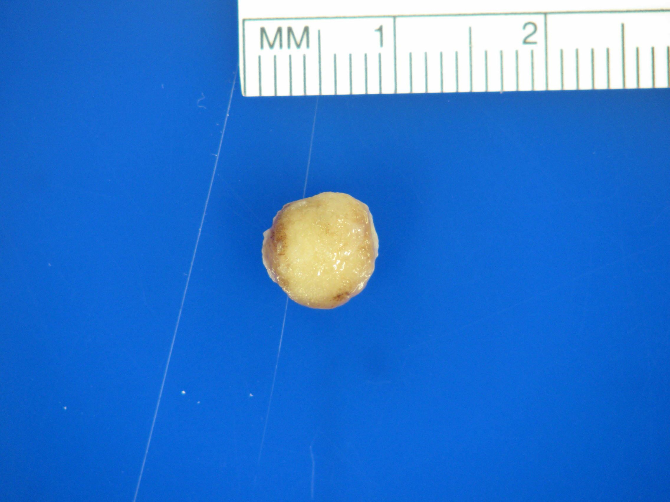 Pathology Outlines - Inflammatory fibroid polyp