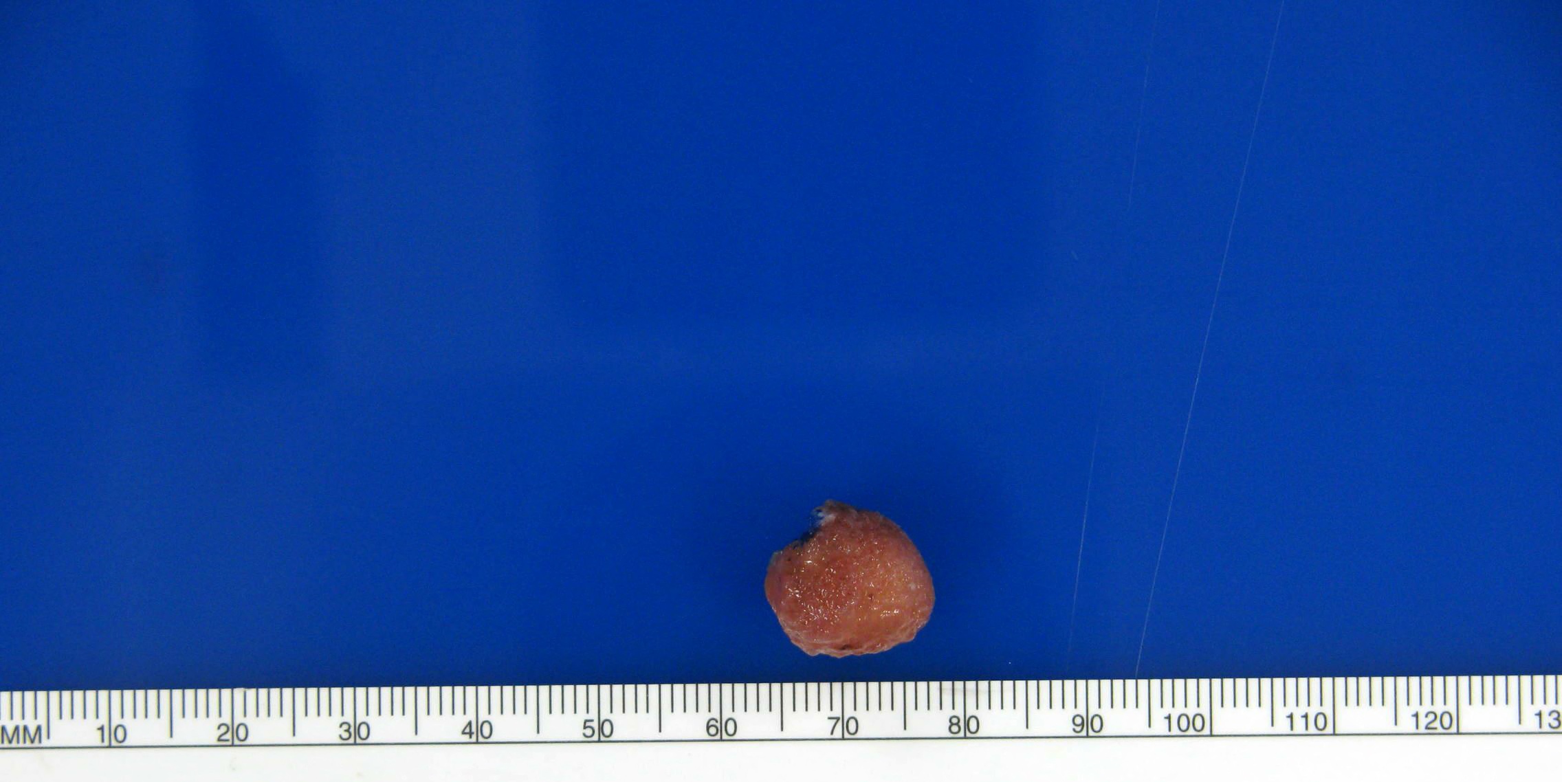 Pathology Outlines - Inflammatory fibroid polyp