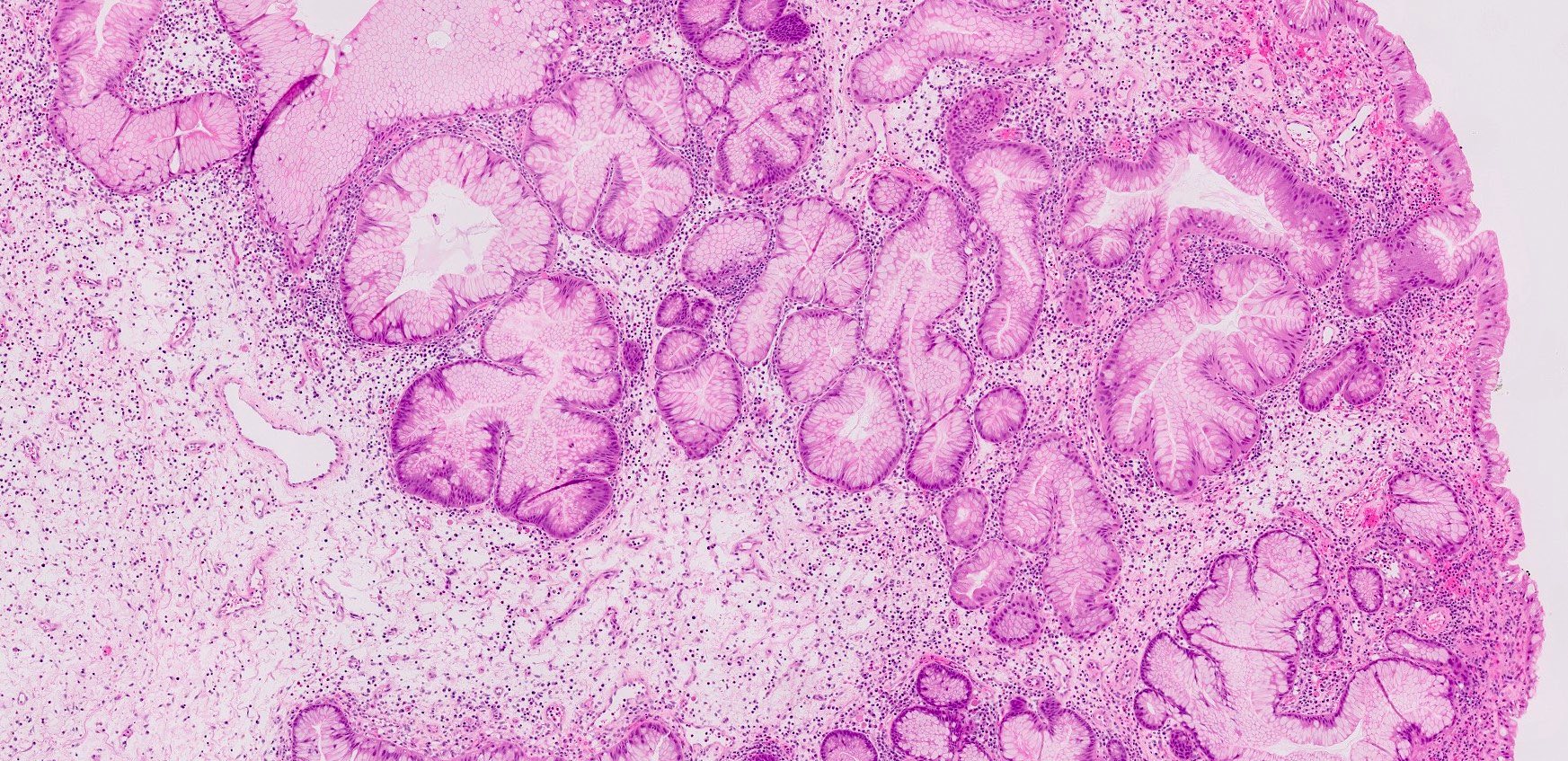Hyperplastic Polyp Pathology Outlines Clinical Pathology Intestinal