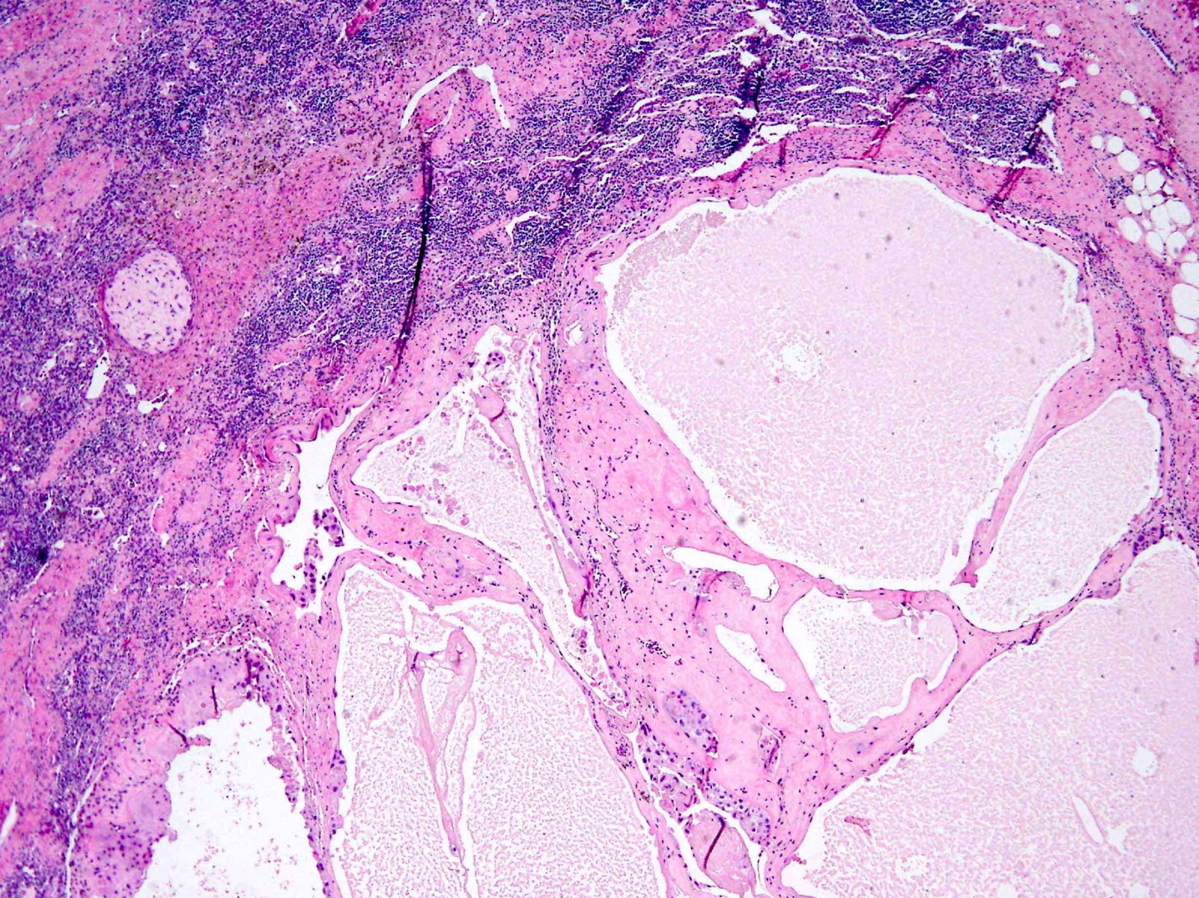 Pathology Outlines - Cystic trophoblastic tumor