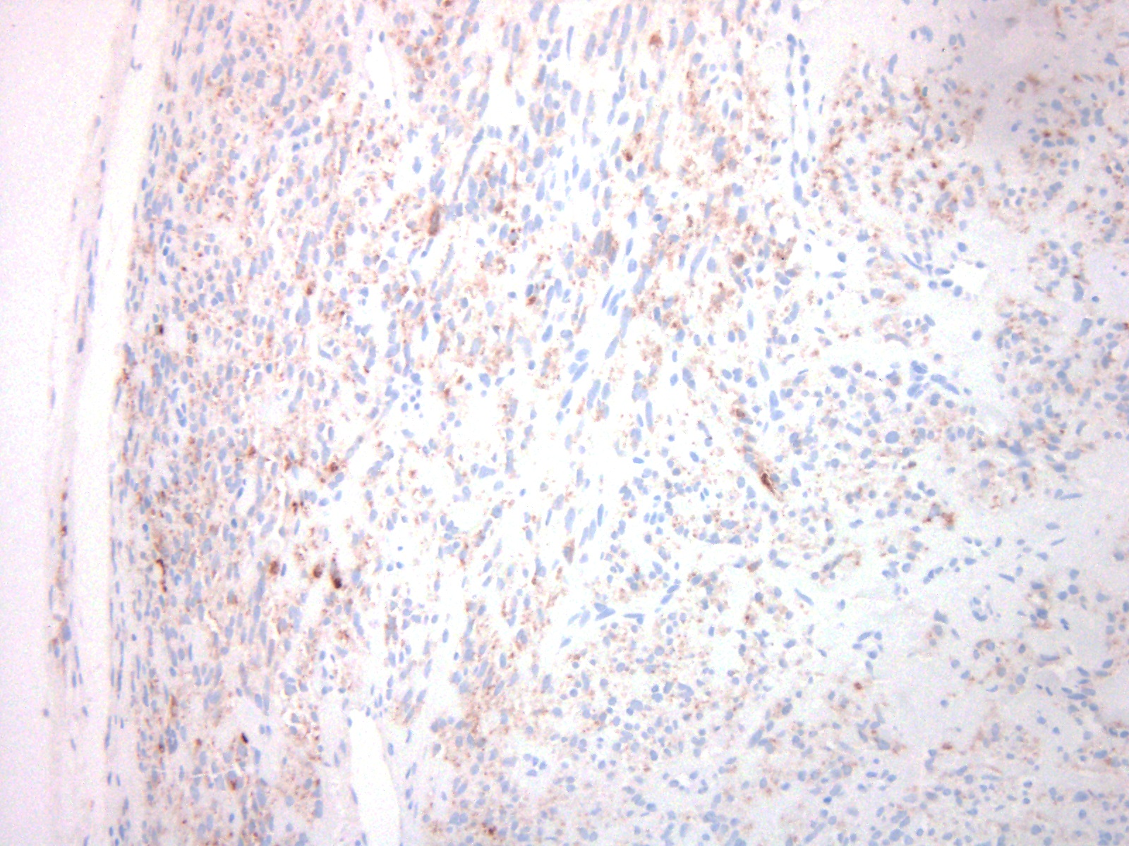 Pathology Outlines - Fibroma thecoma group