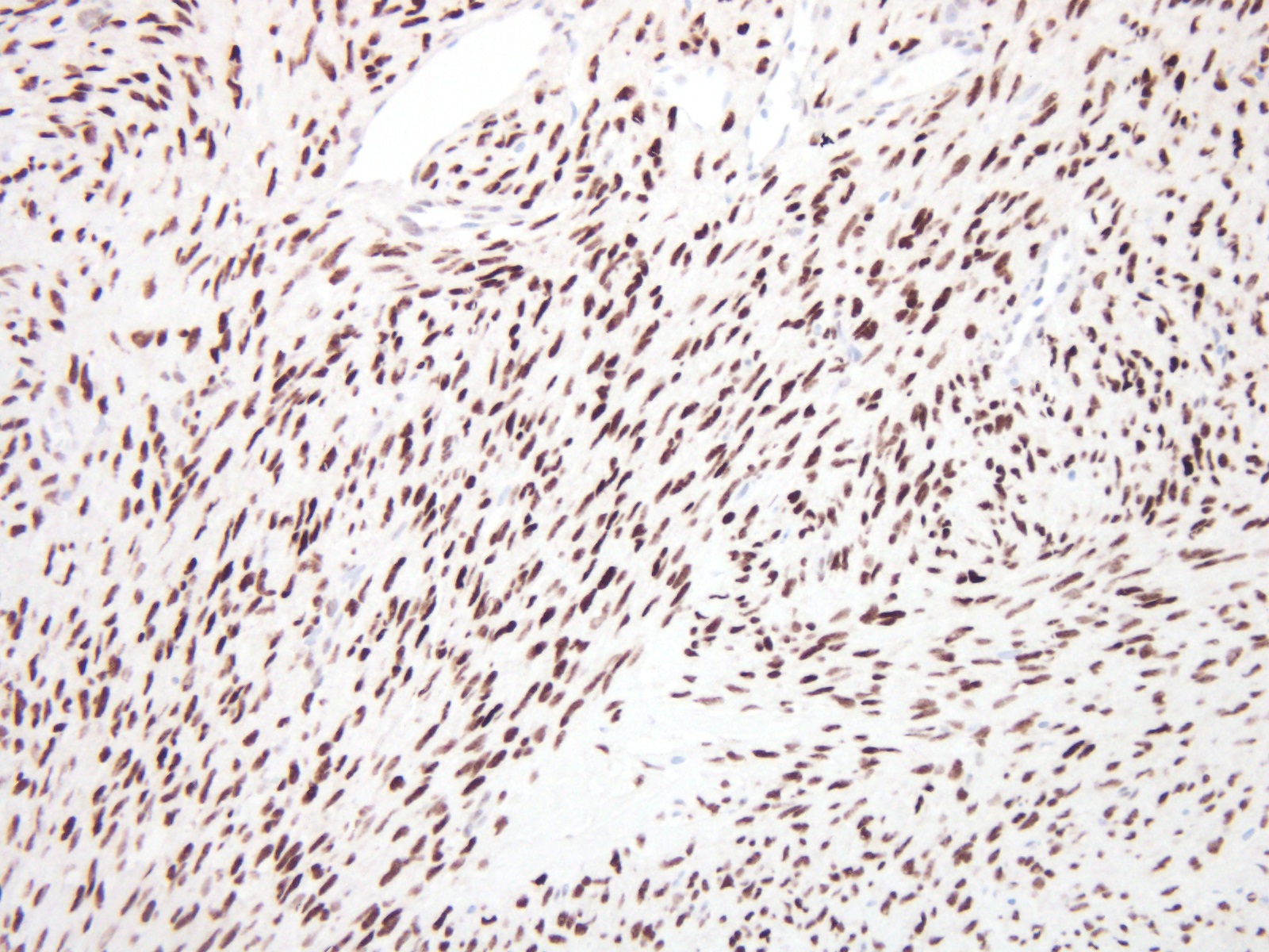 Pathology Outlines - Fibroma thecoma group