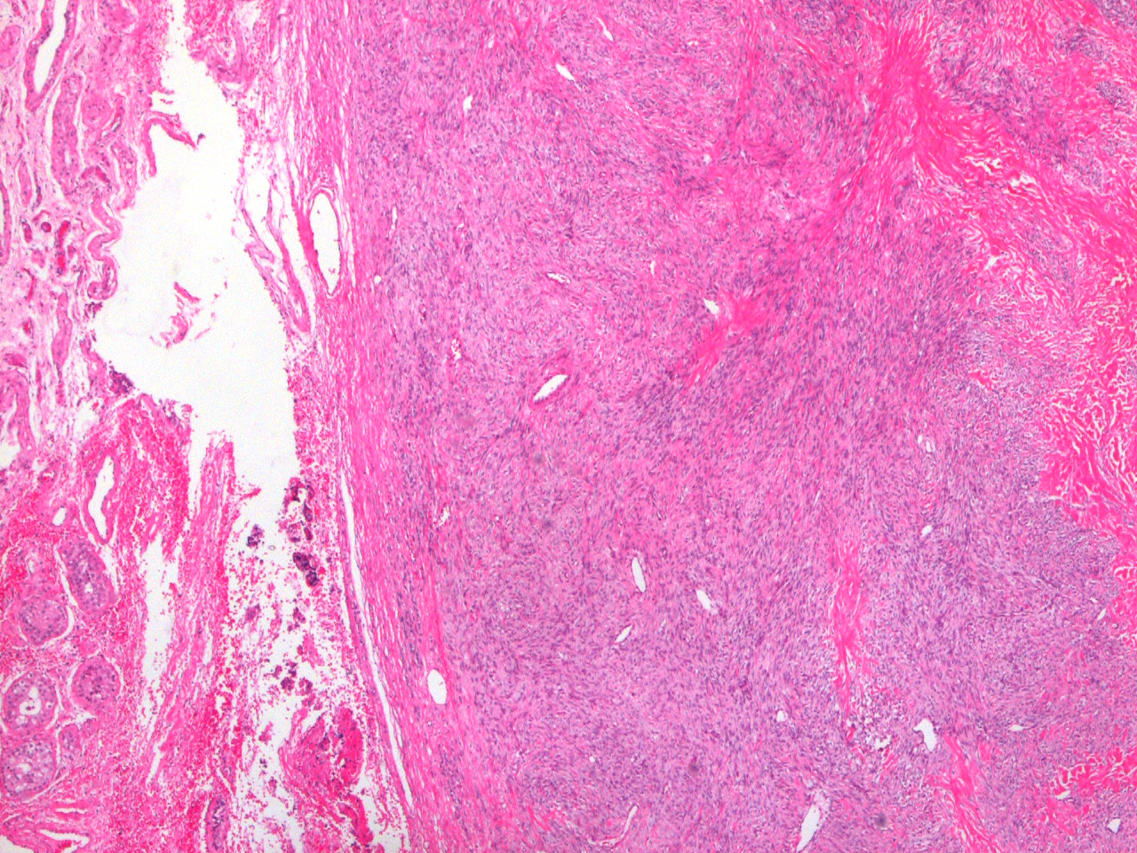 Pathology Outlines - Fibroma thecoma group