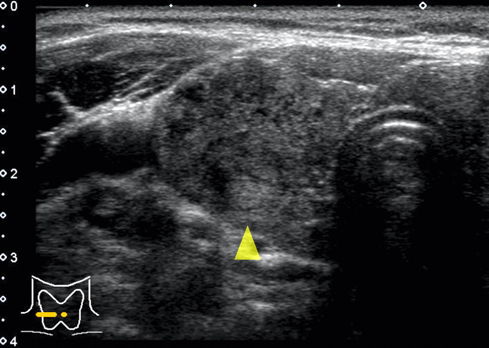 Hashimotos Thyroiditis Ultrasound