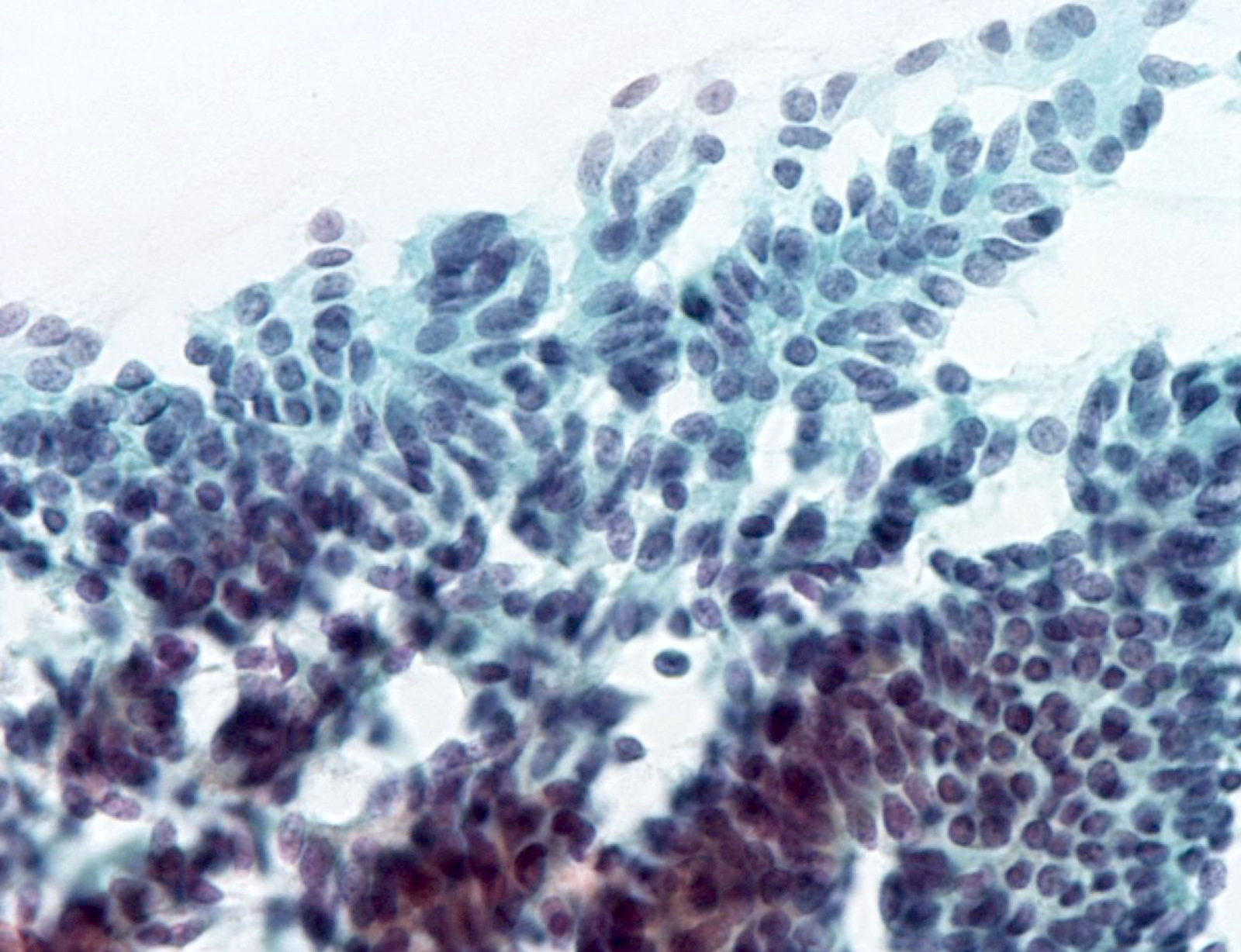 Pathology Outlines - Columnar cell
