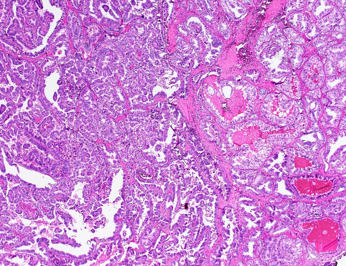 Pathology Outlines - Columnar cell