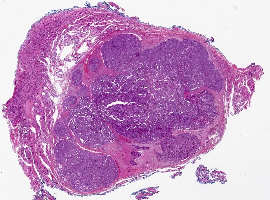 Pathology Outlines - Cribriform-morular thyroid carcinoma