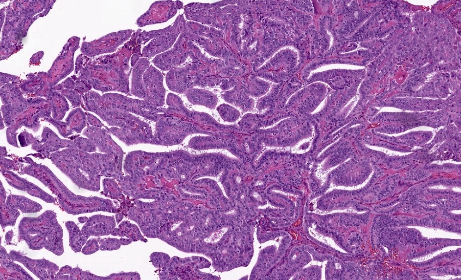 Pathology Outlines - Cribriform-morular thyroid carcinoma