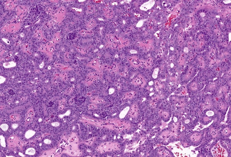 Pathology Outlines - Cribriform-morular thyroid carcinoma
