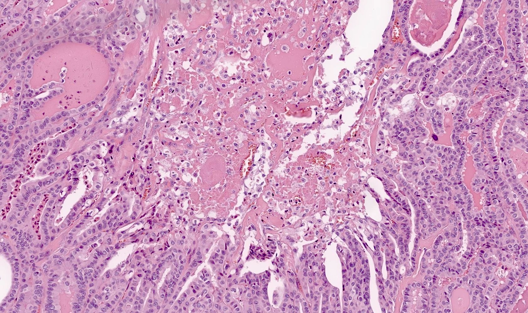 Pathology Outlines - Differentiated high grade thyroid carcinoma / high ...