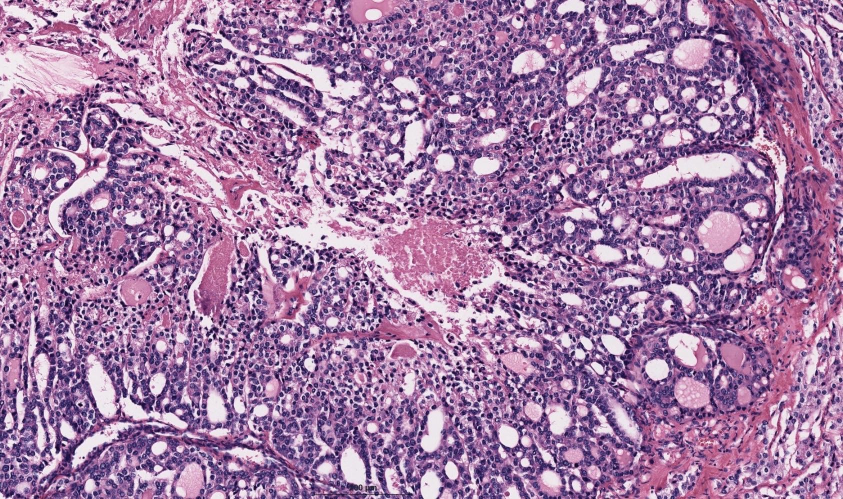 Pathology Outlines - Differentiated high grade thyroid carcinoma / high ...