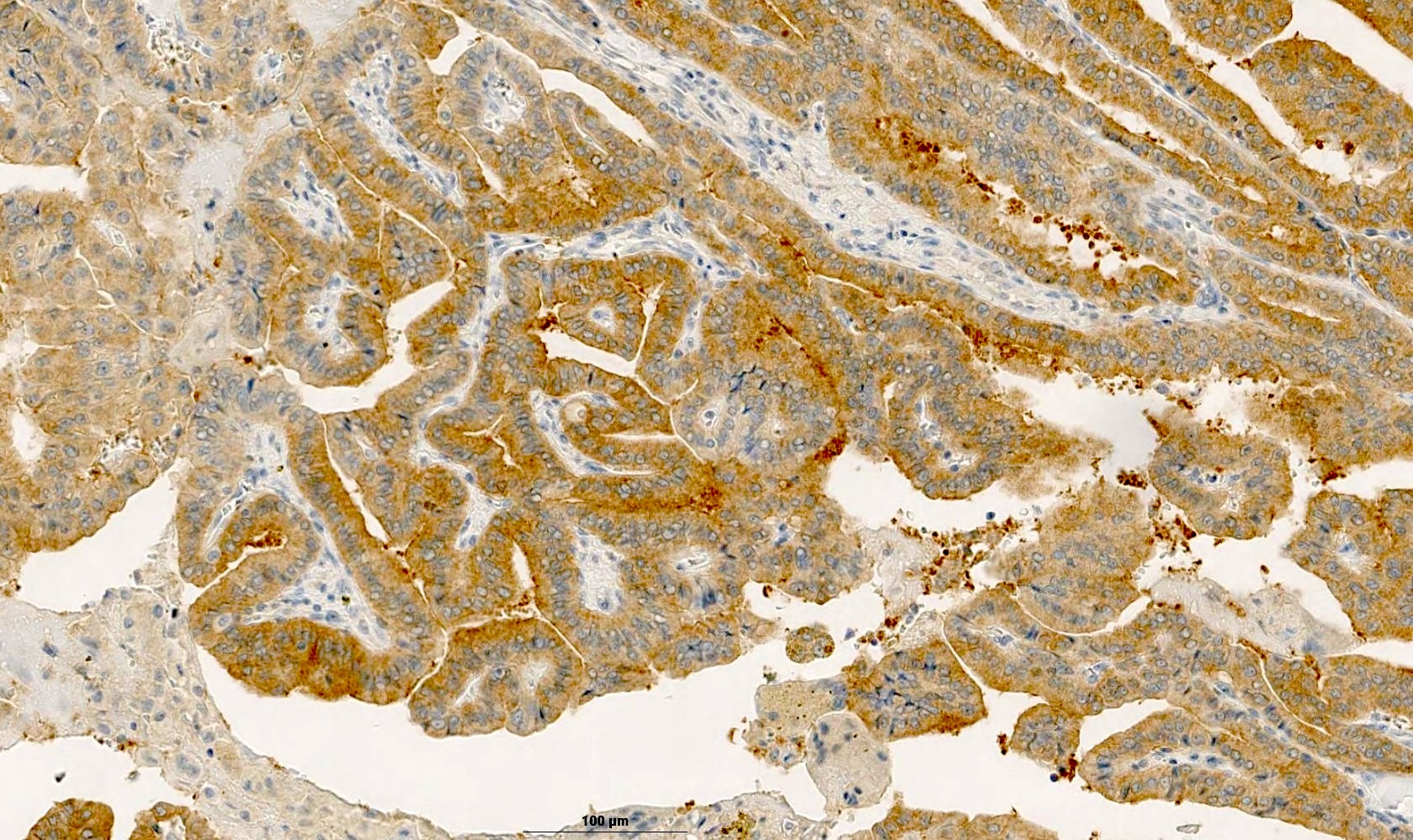 Pathology Outlines - Differentiated high grade thyroid carcinoma / high ...