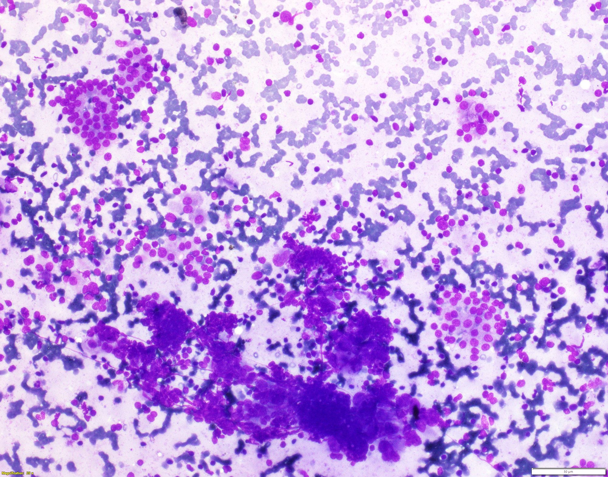 Pathology Outlines - Hashimoto thyroiditis