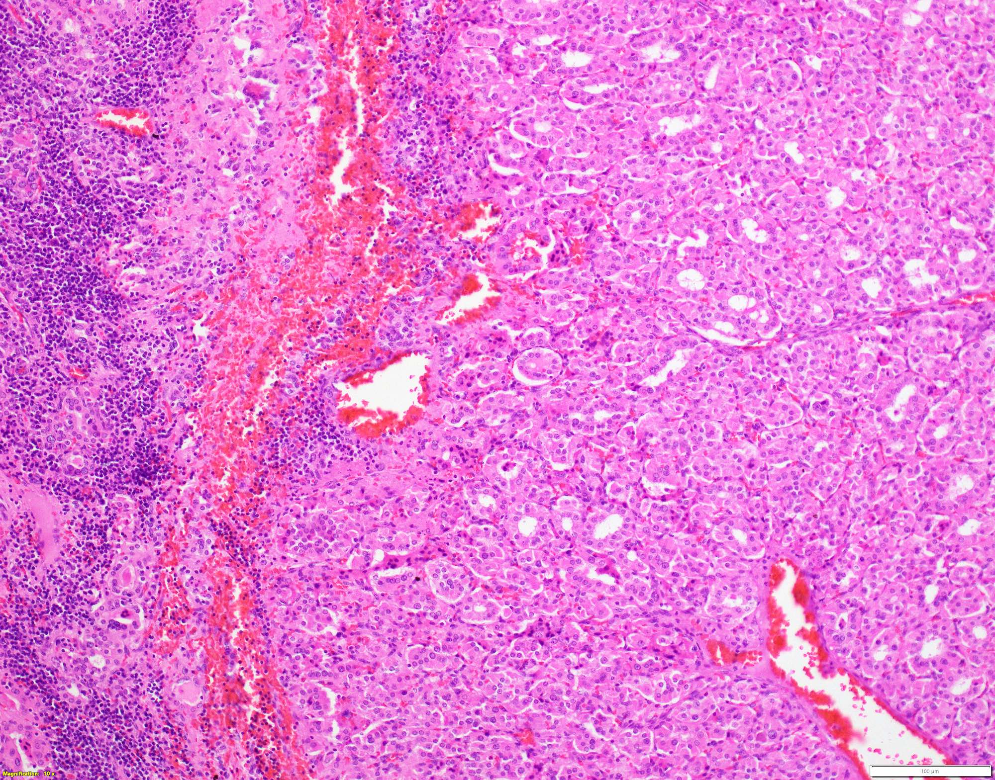 Pathology Outlines - Hashimoto thyroiditis