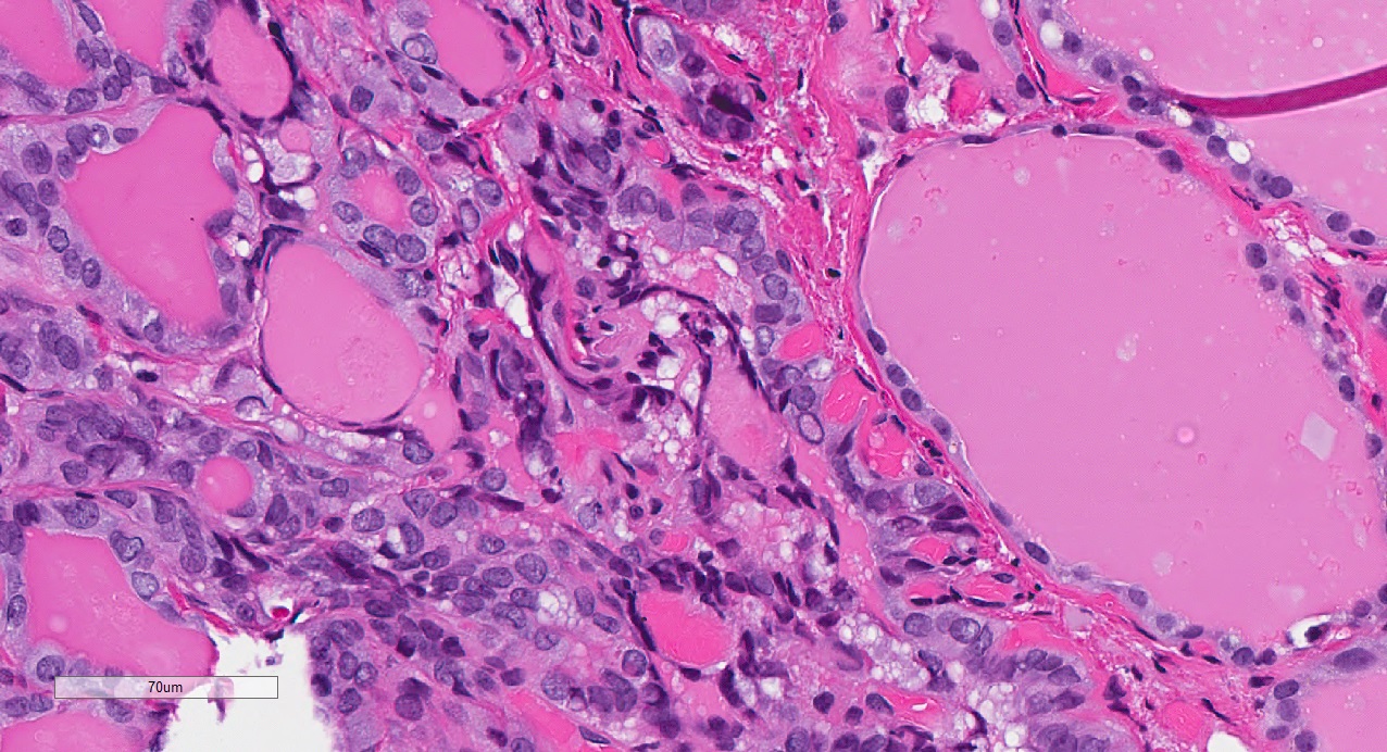 Pathology Outlines - Microcarcinoma