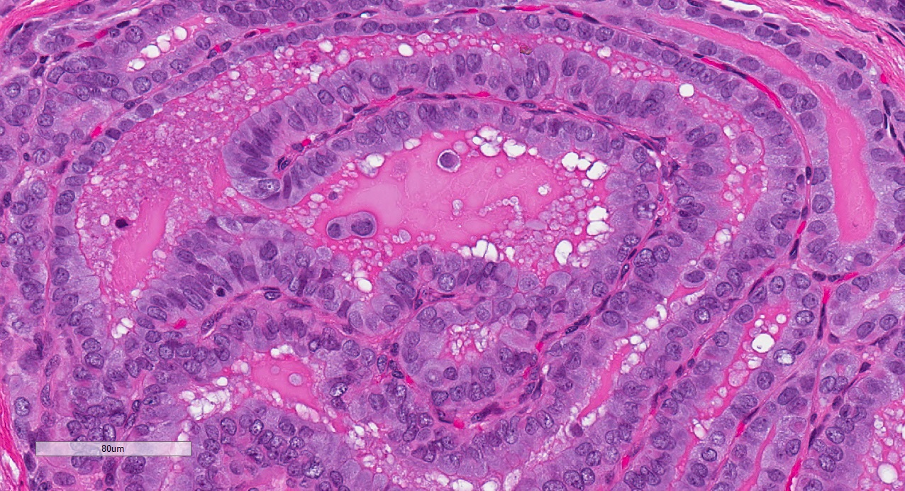 Pathology Outlines - Microcarcinoma