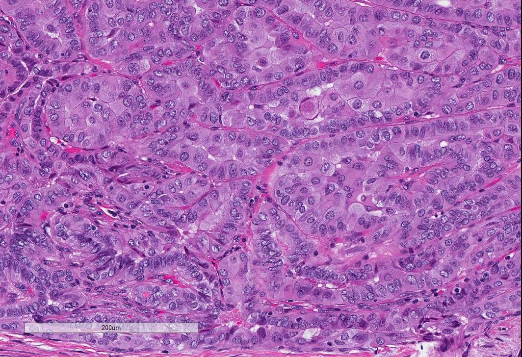 Pathology Outlines - Microcarcinoma