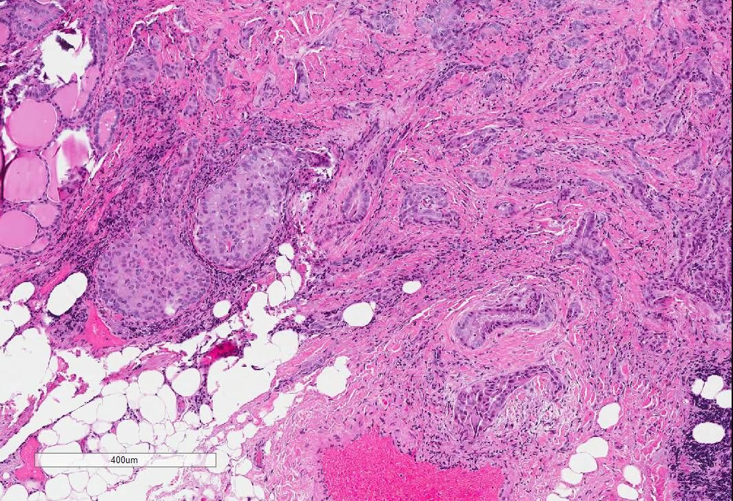 Pathology Outlines - Microcarcinoma