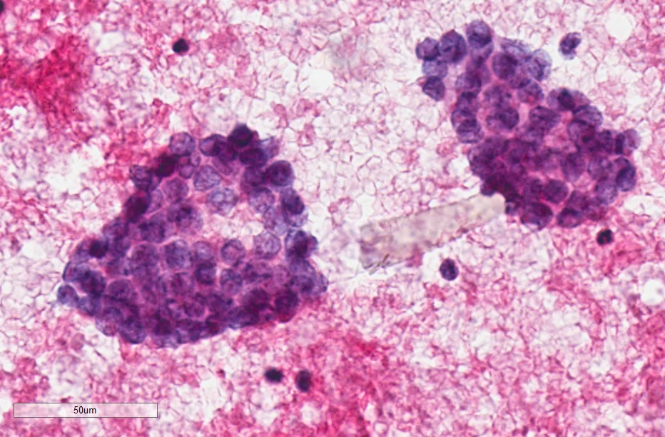 Pathology Outlines - Microcarcinoma