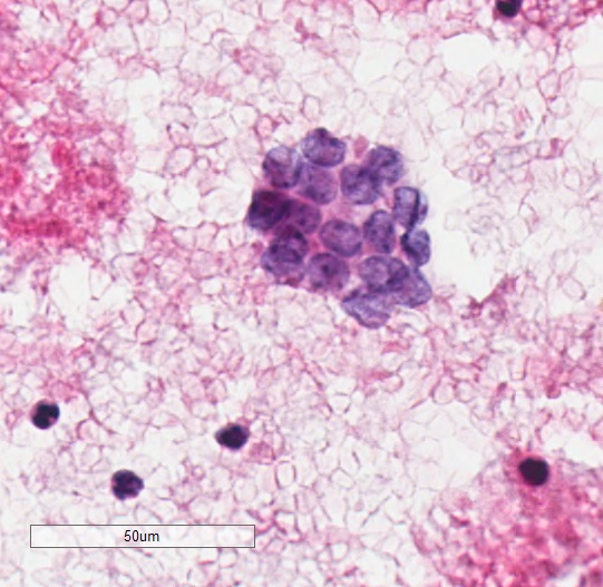 Pathology Outlines - Microcarcinoma