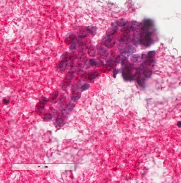 Pathology Outlines - Microcarcinoma
