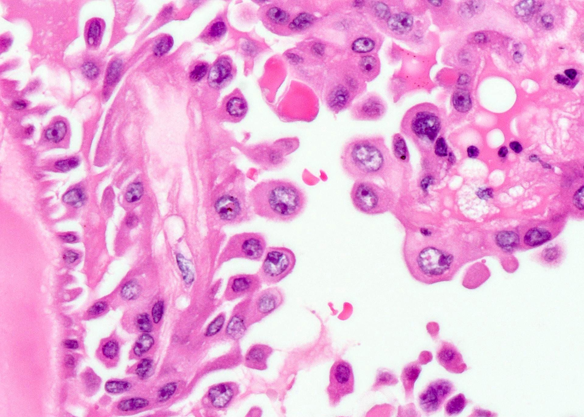 Pathology Outlines - Hobnail