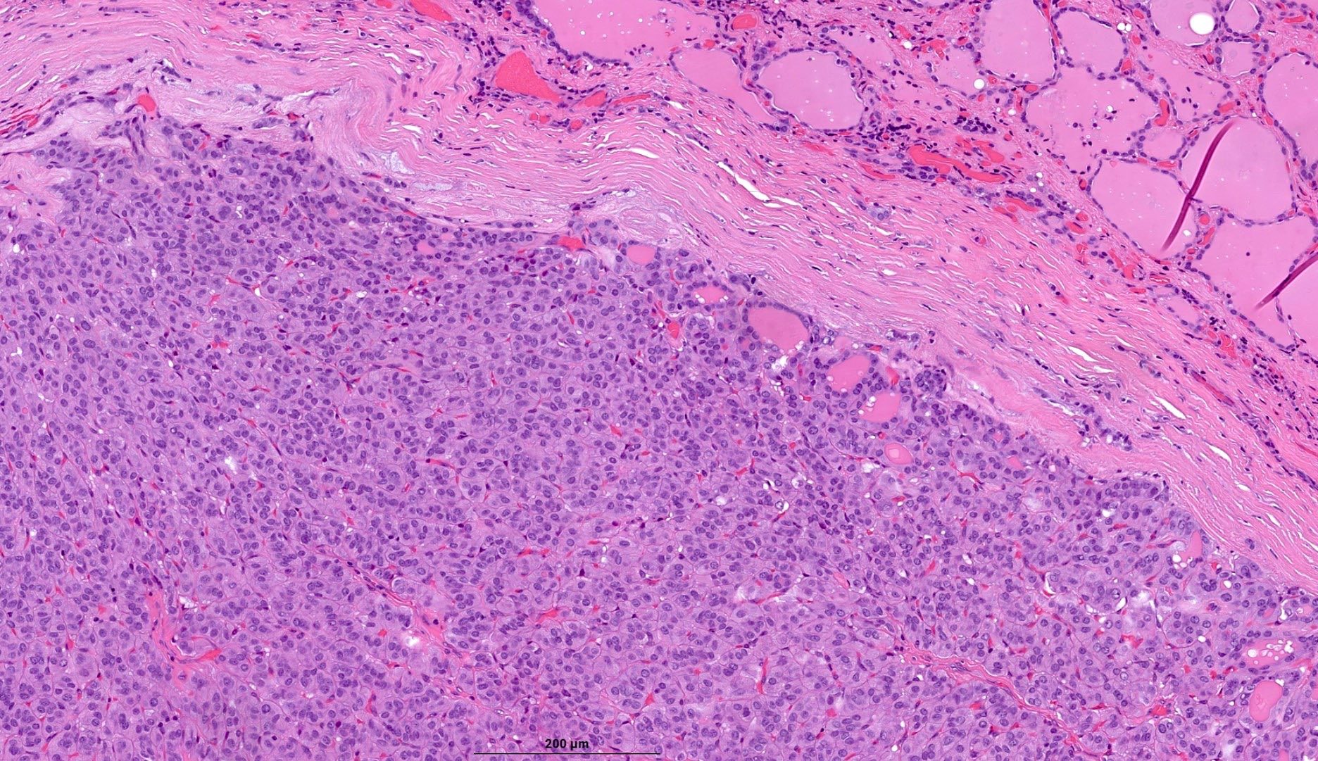 Pathology Outlines - Solid / trabecular