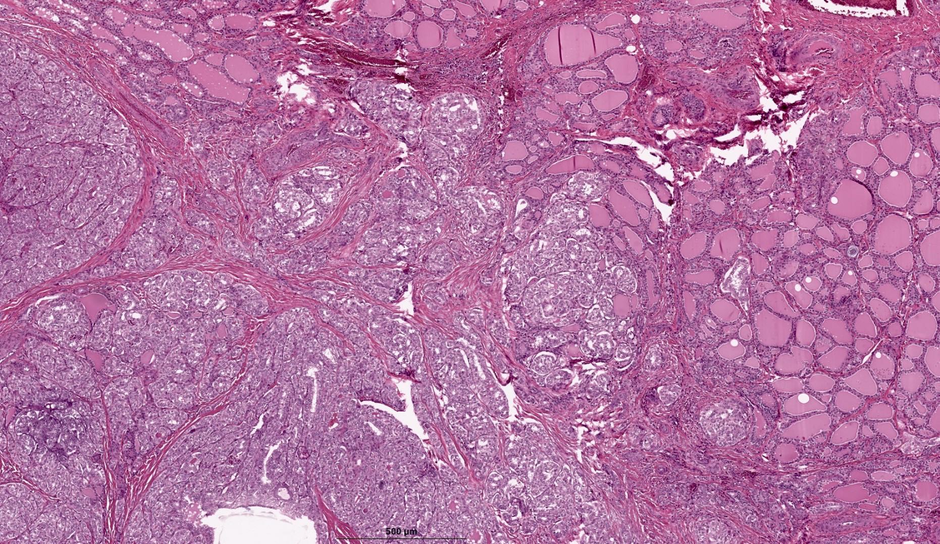 Pathology Outlines - Solid / trabecular