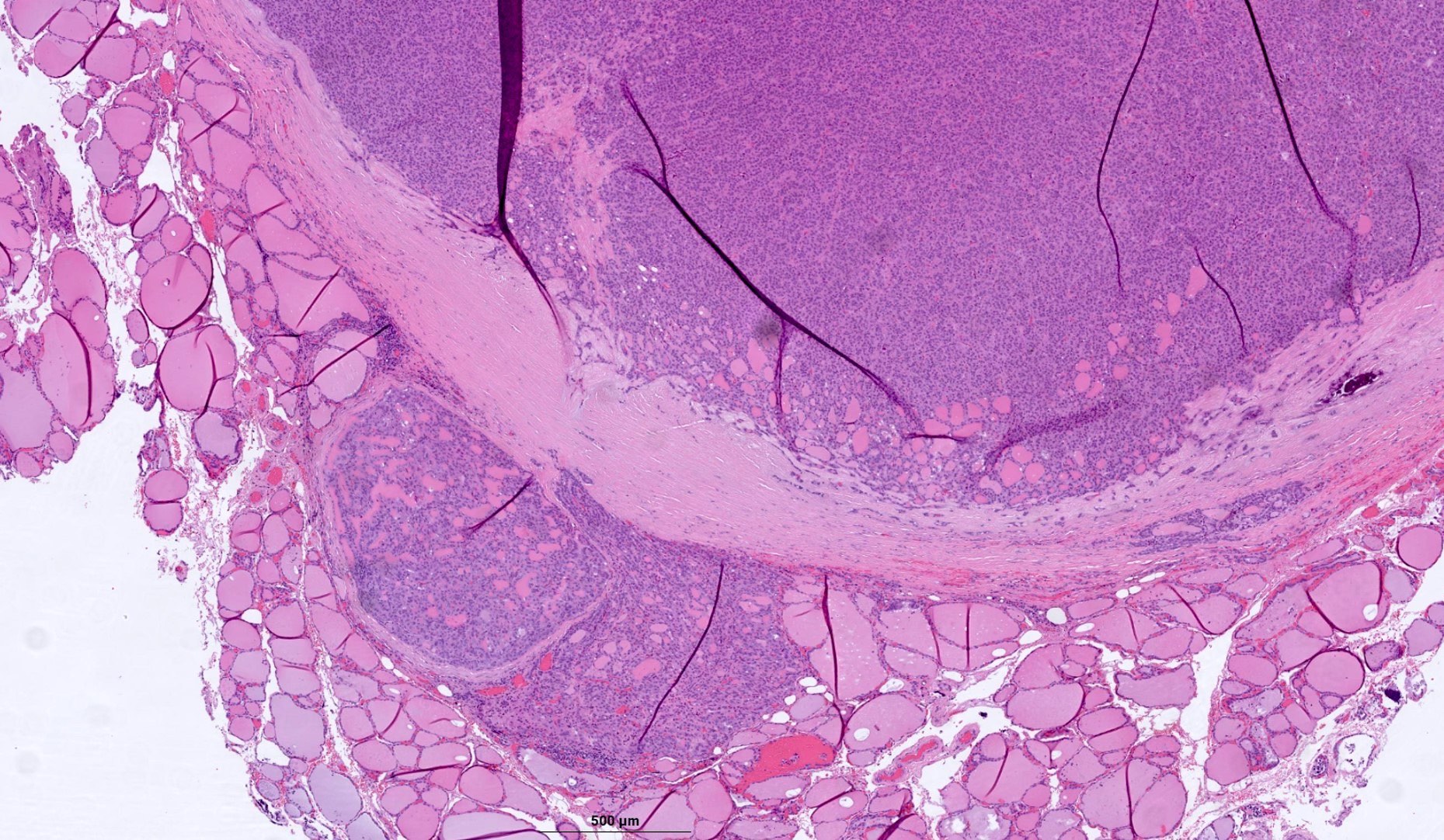 Pathology Outlines - Solid / trabecular