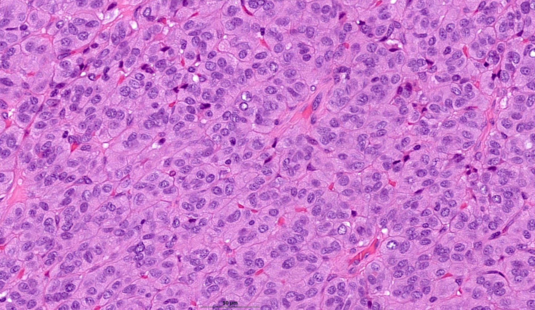 Pathology Outlines - Solid / trabecular