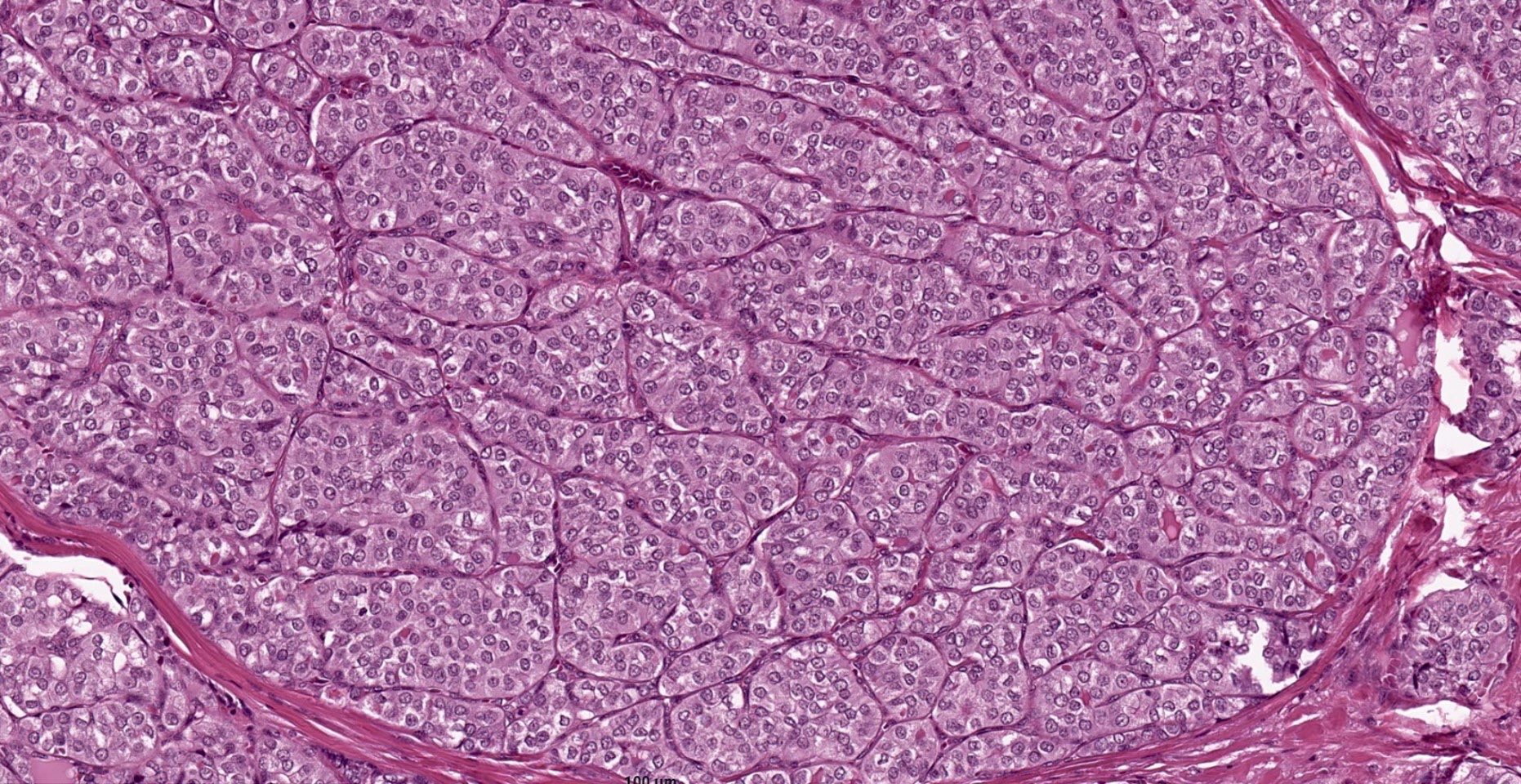 Pathology Outlines - Solid / trabecular