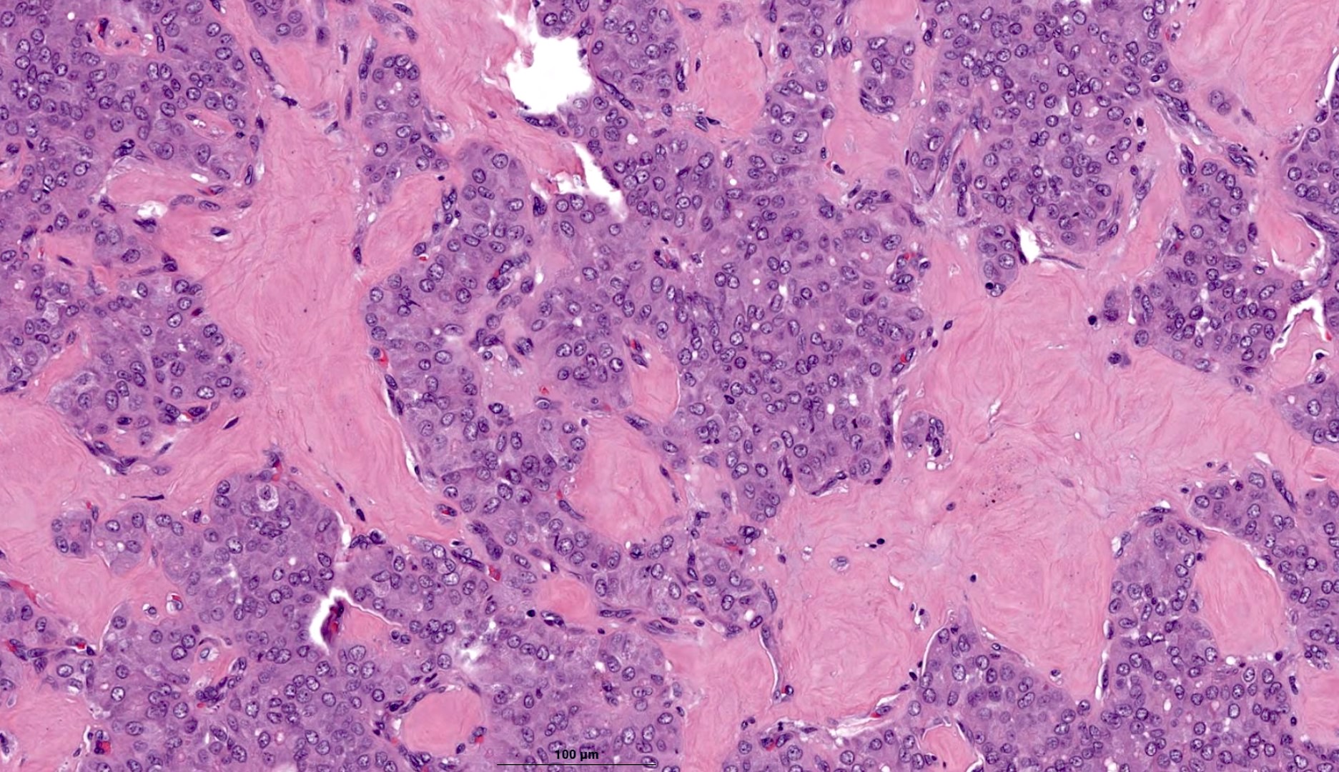 Pathology Outlines - Solid / trabecular