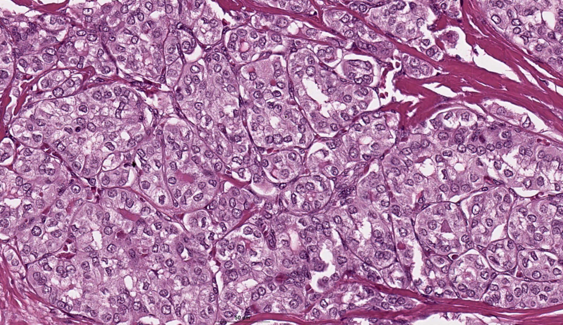 Pathology Outlines - Solid / trabecular