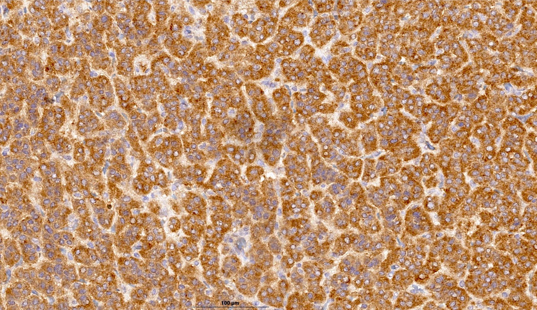Pathology Outlines - Solid / trabecular