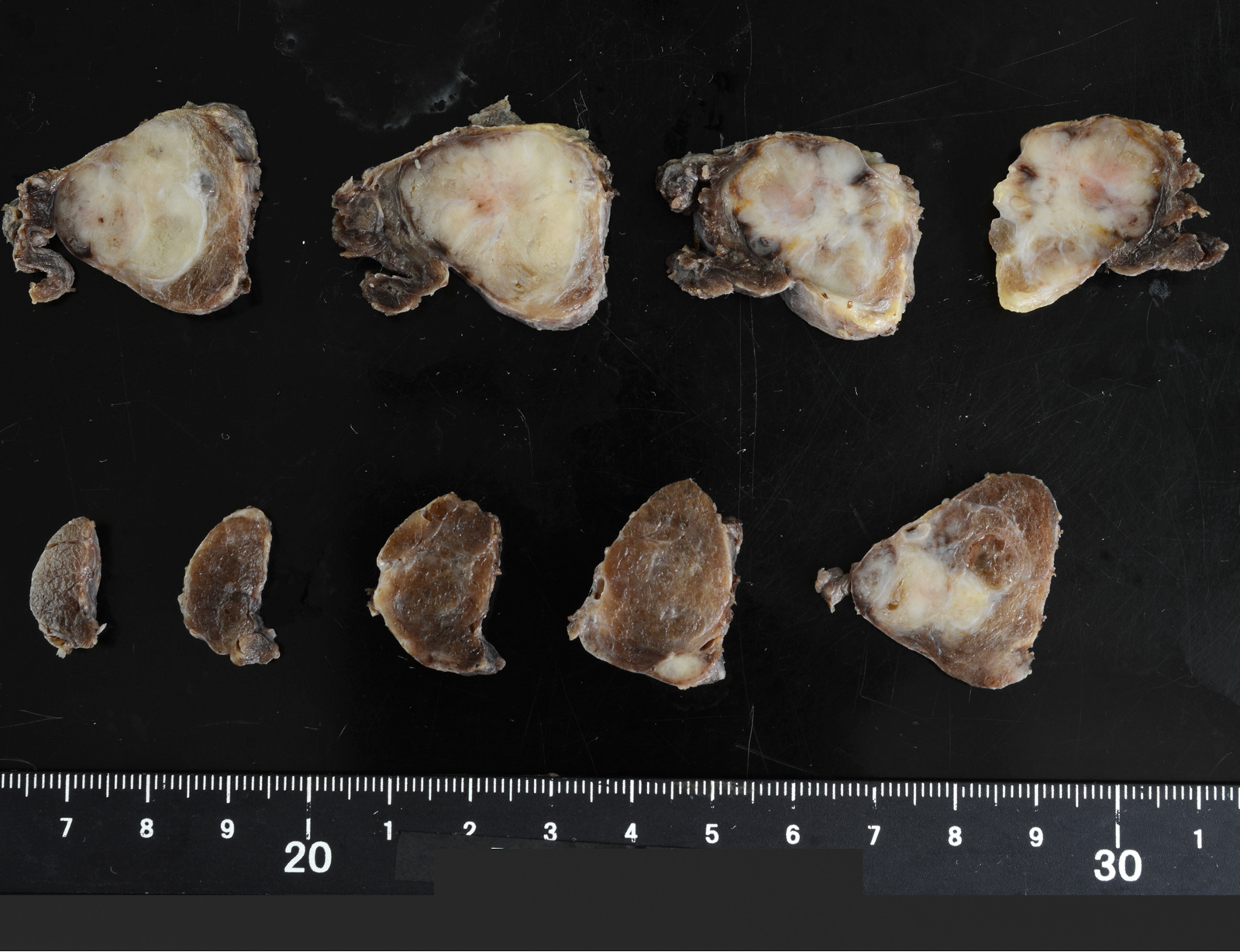 Pathology Outlines - Tall cell