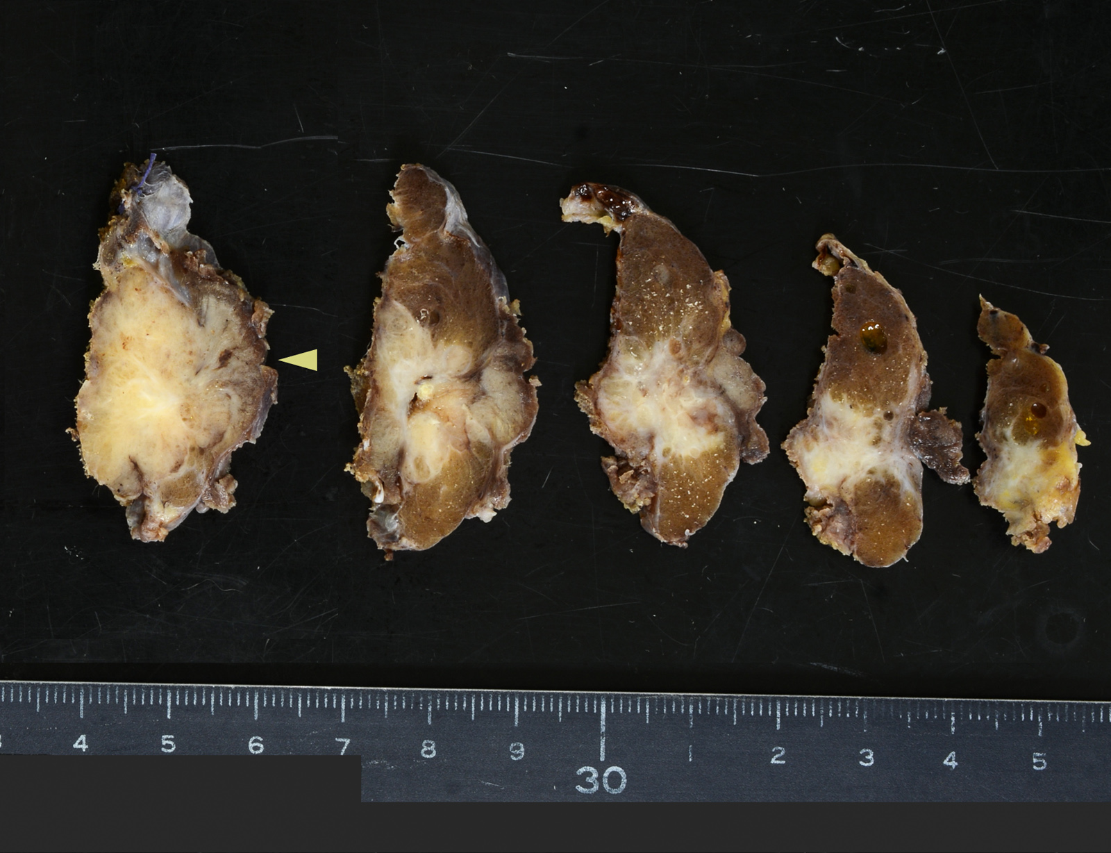 Pathology Outlines - Tall cell
