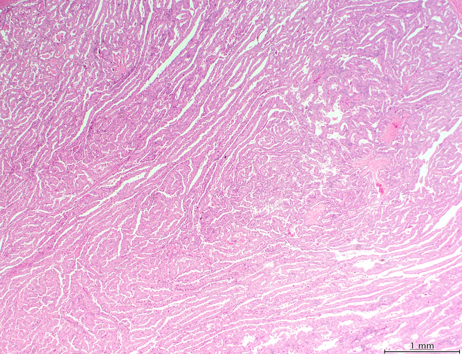Pathology Outlines - Tall cell