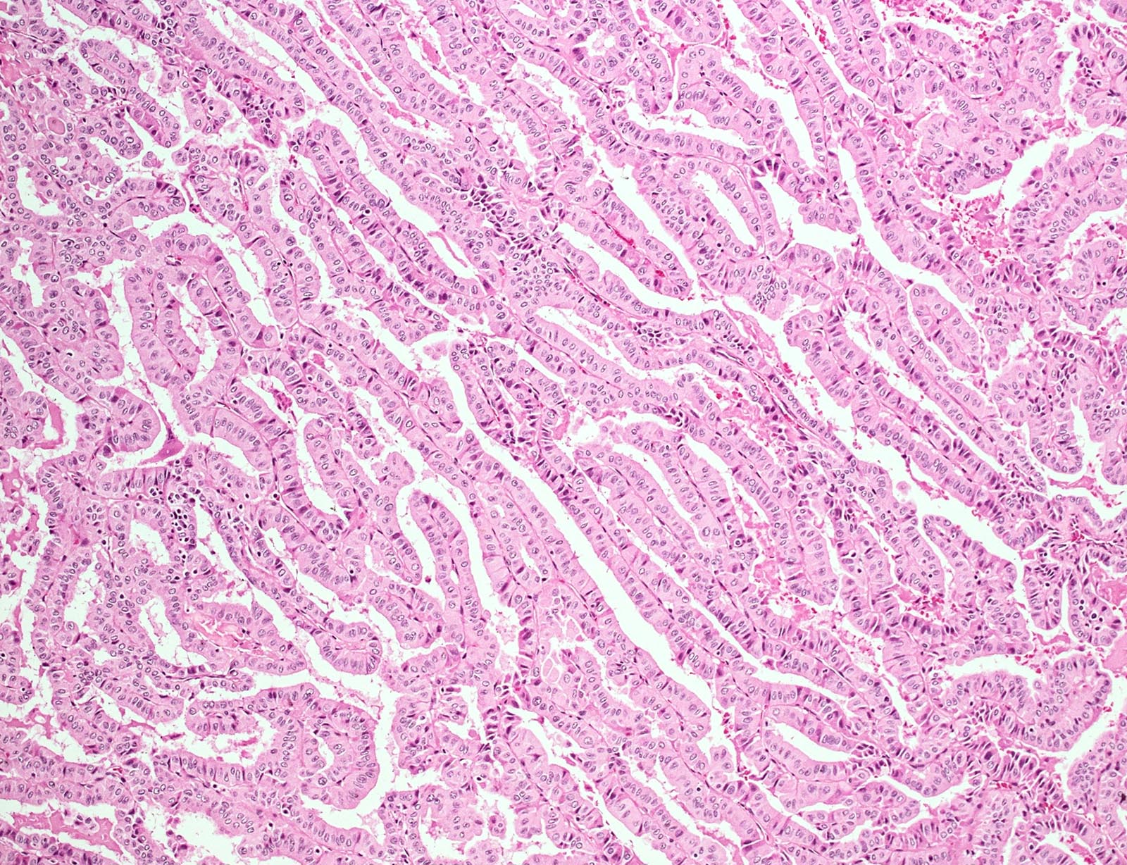 Pathology Outlines - Tall cell